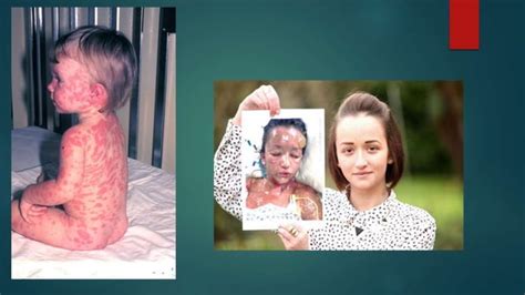 Mutatiile Genetice Anomalii Genice Si Cromozomiale Pptx