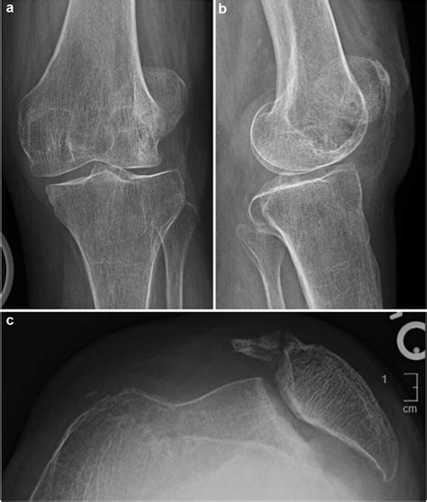 Knee Patellar Dislocation X Ray