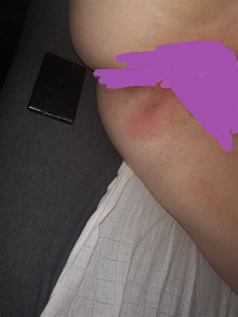 Je To Absces Modrý Koník