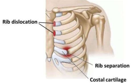 Dislocated Rib Symptoms Treatment Causes Diagnosis Complications