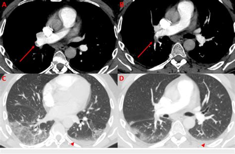 Axial Cta Pe Protocol Of The Chest A B Shows An Occlusive Thrombus