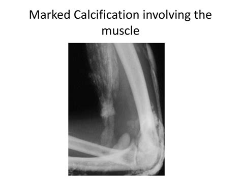 Scleroderma Ppt Video Online Download