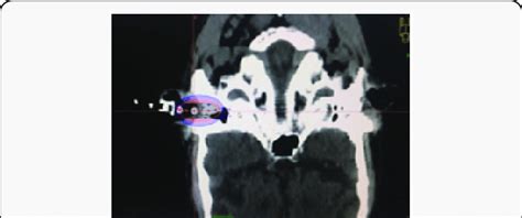 B Brt Dose Distribution With Isodose Representation Download