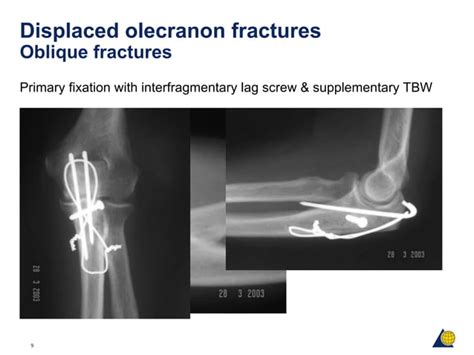 Olecranon Fracture And Patellar Fractures Ppt