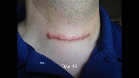 Thyroidectomy Partial Or Total Thyroidectomy Recovery And Complications