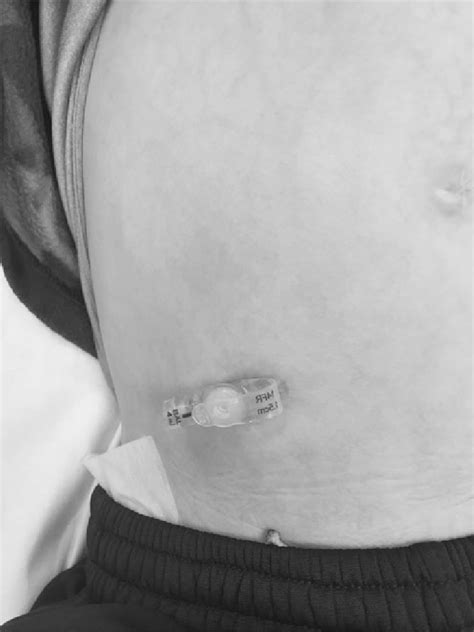 Low Profile Balloon Button After Laparoscopic Appendicostomy Procedure