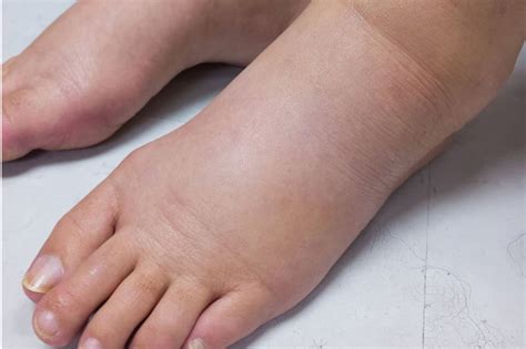 داء الفيل الأعراض الاسباب التشخيص العلاج المضاعفات حياة Haeat