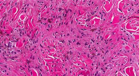 Dermatofibroma Ottawa Atlas Of Pathology