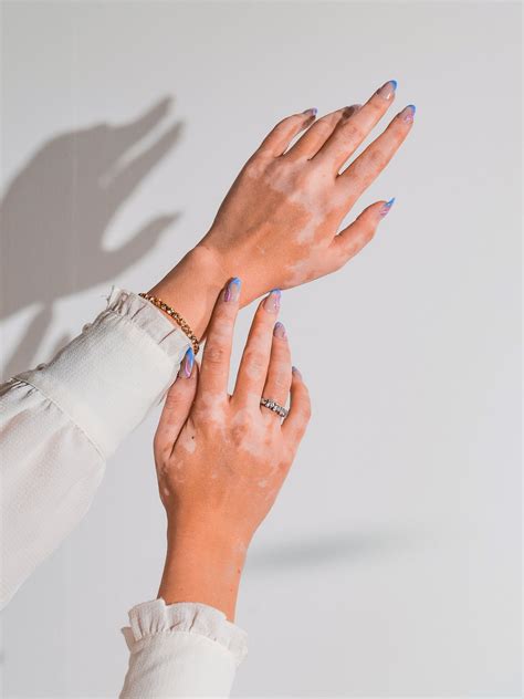 Vitiligo Kit Best Vitiligo Treatment Creams From Verduracare
