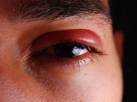 Cellulitis Symptoms Causes Pictures And Treatment