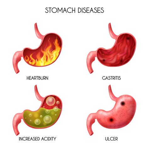 Stomach Diseases Causes Symptoms Prevention And Treatment Health
