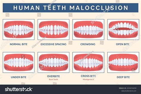 Malocclusion Human Teeth Infographic Icon Set Stock Vector Royalty