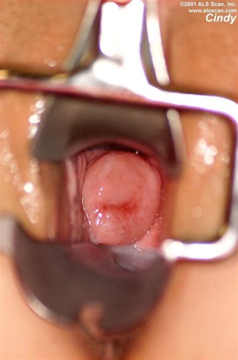 Girls From ALS Scan Photo 138 719 X3vid Com