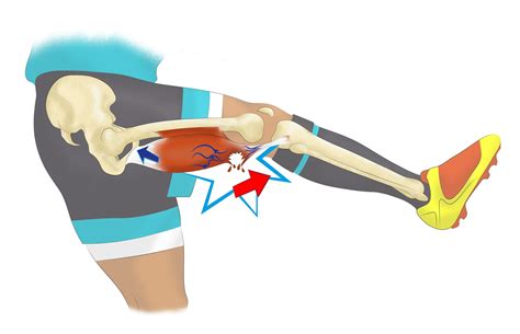 Comment soigner une déchirure musculaire