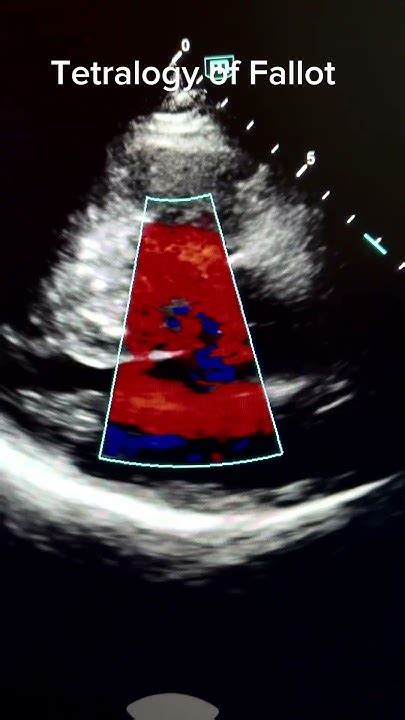 Tetralogy Of Fallot Cardiology Echocardiography Youtube
