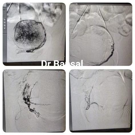 Dr Rajendra Bansal On Linkedin Uterus Uterinefibroids Fibroids Ufe