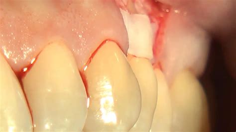 Colgajo De Avance Coronal Ctg Para El Tratamiento De Una Recesi N