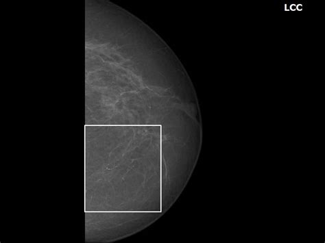 Costochondral Calcification