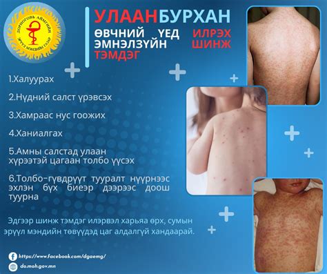 Дорноговь аймгийн Эрүүл мэндийн газар Улаанбурхан өвчний үед илрэх