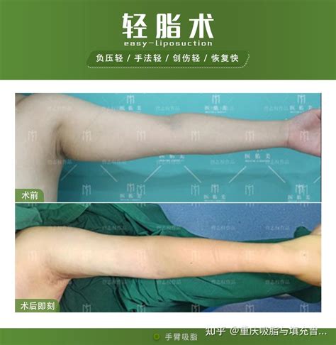 做大腿吸脂手术会不会很痛？会不会反弹？ 知乎