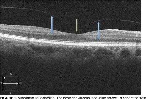 Figure 1 From Idiopathic Epiretinal Membrane And Vitreomacular Traction