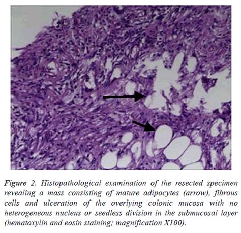 Colonic Intussusception Caused By An Ulc Biomedical Research