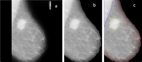 Segmentation Of Image Mdb168 A Original Image B Mammography Image Download Scientific