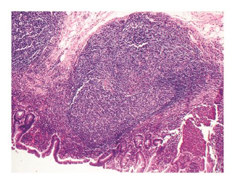 Hande Stained Sections Demonstrating Focal Chronic Active Colitis