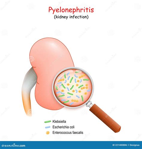 Pyelonephritis Cartoons Illustrations And Vector Stock Images 1211