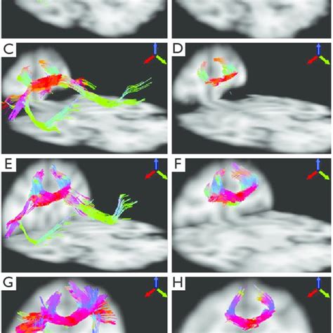 Comparison Of Dti And Dsi Tractography In The White Matter Region With Download Scientific