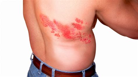 Herpes Zoster Shingles Recognising Symptoms Providing First Aid And Staying Protected