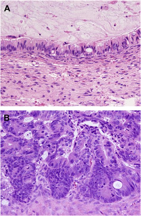 Mucinous Ovarian Tumors Surgical Pathology Clinics