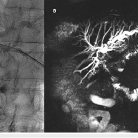 Cholangiography A And Cholangio Mri B Showing Dilatation Of