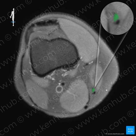 Axial Mri Of Lower Limb Distal Part Of The Femur Level Section 5 23