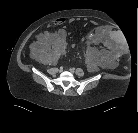 Ct Case 090 • Litfl • Ct Scan Interpretation