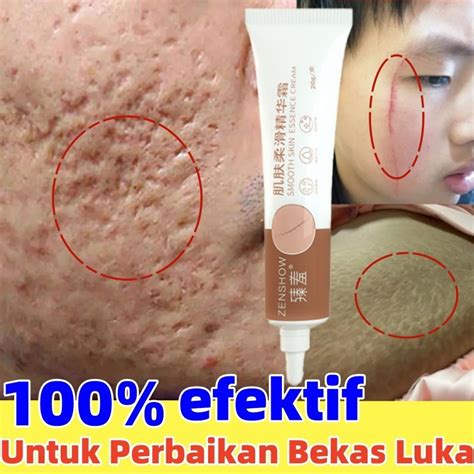 Jual Penghilang Bekas Luka Menghilangkan Bekas Luka Penghilang Bekas