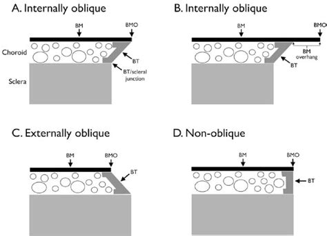 Figure 1 From Optic Disc Margin Anatomy In Glaucoma Patients And Normal Controls With Spectral