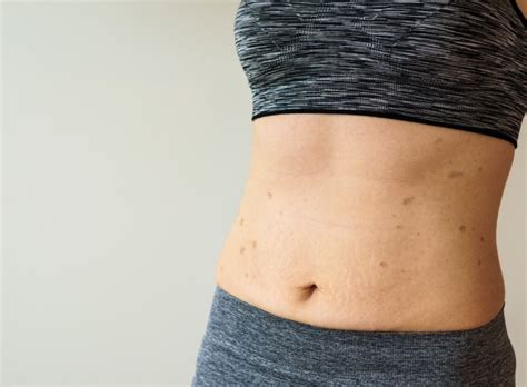 Lichen Planus Dermatology Associates