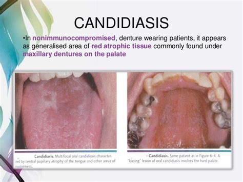 Tongue And Palate Candida
