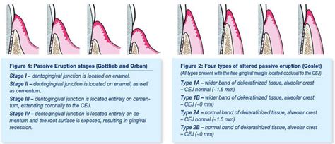 Altered Passive Eruption Diagnosis And Treatment