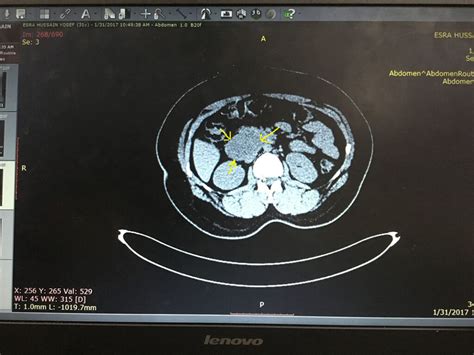 Retroperitoneal Non Functioning Paraganglioma Simulating A Pancreatic