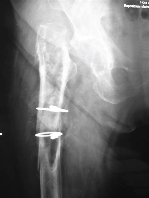Quality Of Life After Girdlestone Resection Arthroplasty Revista