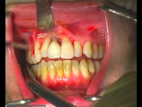 Peri Implantitis Treatment Sequella1 Youtube