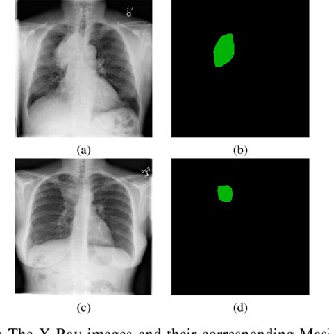 Figure 1 From Analysis Of Underfitting And Overfitting In U Net Semantic Segmentation For Lung