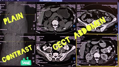 Cect Abdomen Filmingsiemens Healthineers Somatom Go Ct Scan Youtube