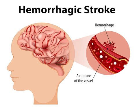 Brain Haemorrhage How To Detect The Treatment Involved Yashoda