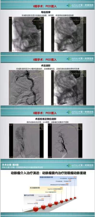 谢万福教授团队手术分享第8期：密网支架 Pipeline Flex 治疗巨大动脉瘤 脑医汇