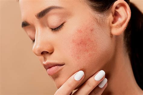 Acne Scar Procedure In Abu Dhabi Elyzee Hospital