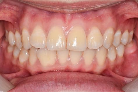 Gum Cancer Pictures