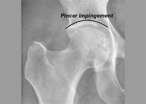 Cam Hip Impingement Cam Deformity In The Hip Ronak Mukesh Patel Md